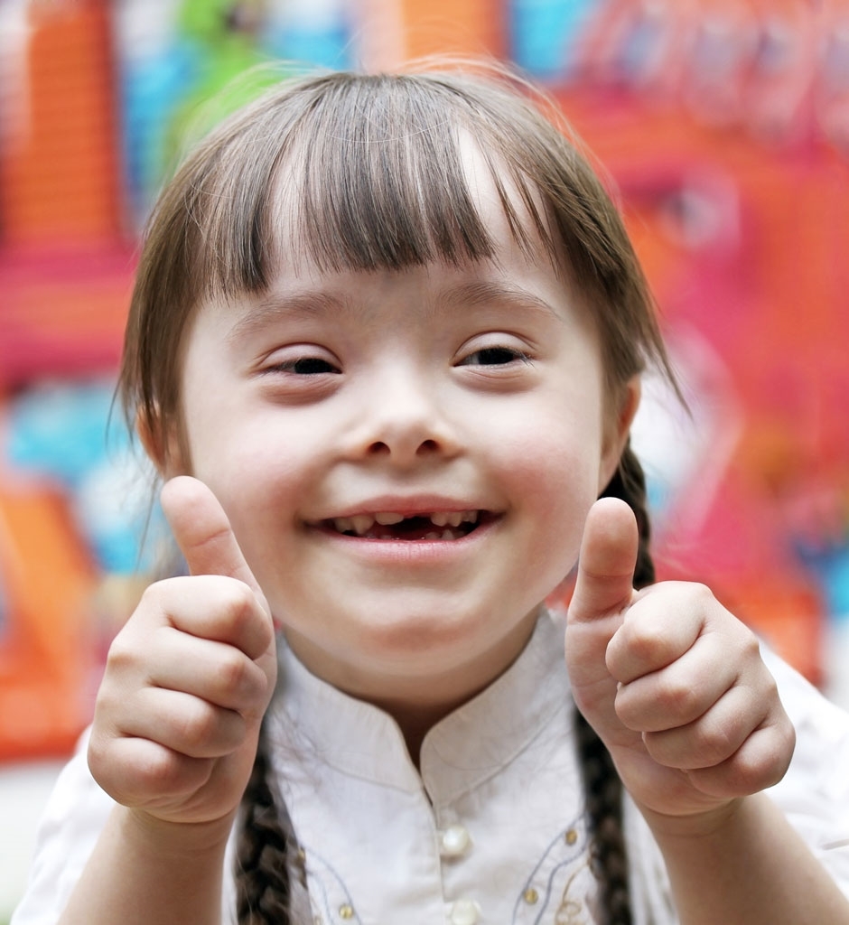 DS (down syndrome) và sự thật bạn cần biết